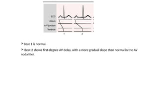ecg on BRADYCARDIA sinus node dysfunction av block | PPTX