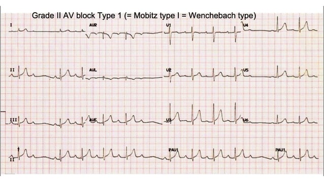 ecg on BRADYCARDIA sinus node dysfunction av block | PPT