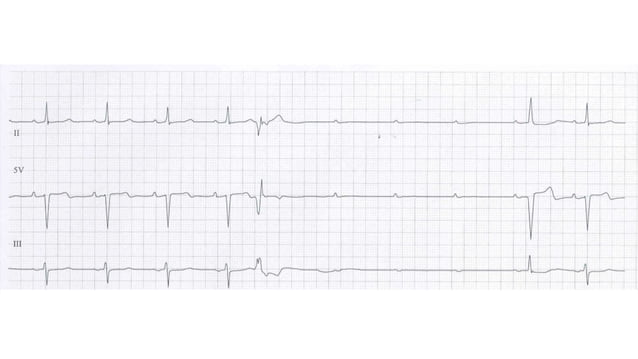 ecg on BRADYCARDIA sinus node dysfunction av block | PPT