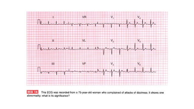ecg on BRADYCARDIA sinus node dysfunction av block | PPT