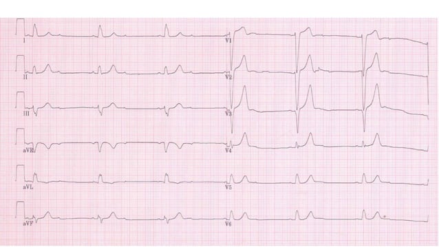ecg on BRADYCARDIA sinus node dysfunction av block | PPT