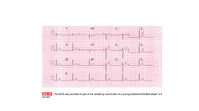 ecg on BRADYCARDIA sinus node dysfunction av block | PPT