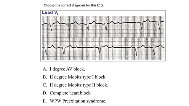 ecg on BRADYCARDIA sinus node dysfunction av block | PPT
