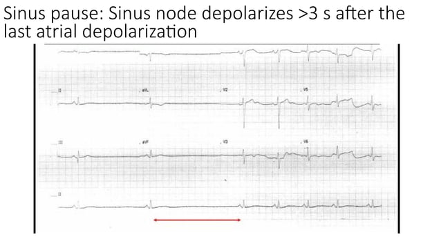 ecg on BRADYCARDIA sinus node dysfunction av block | PPT