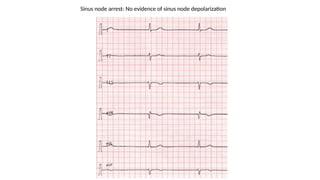 ecg on BRADYCARDIA sinus node dysfunction av block | PPTX