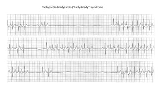 ecg on BRADYCARDIA sinus node dysfunction av block | PPTX