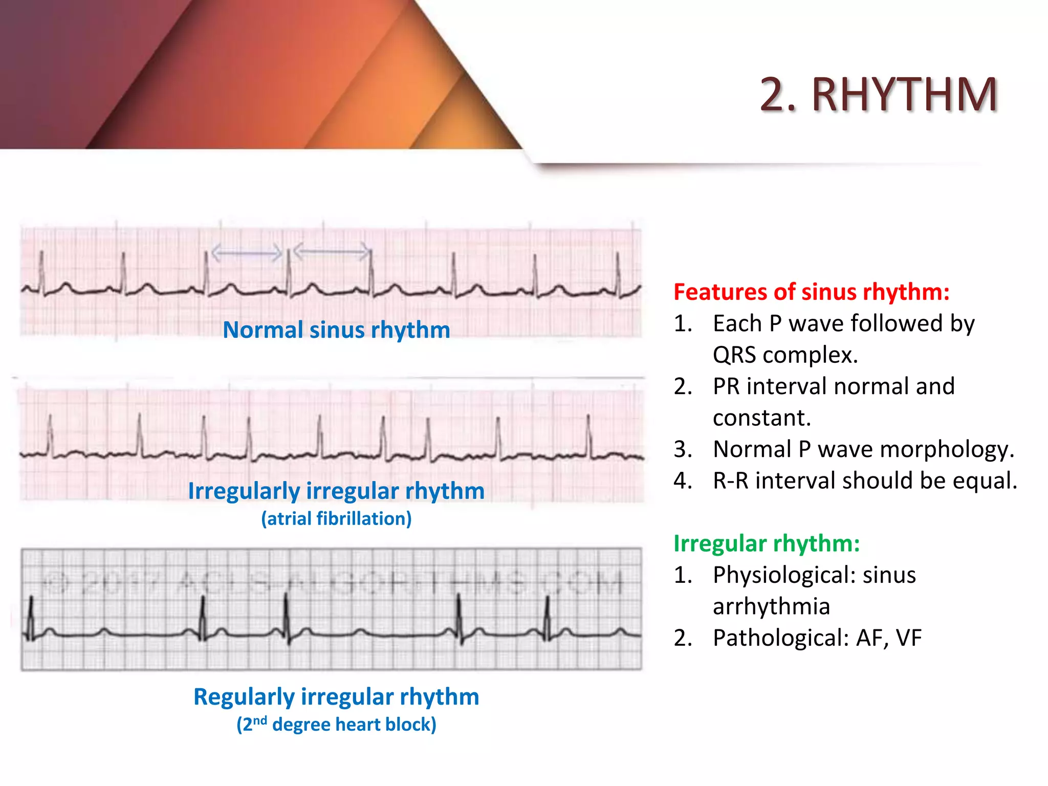 Edited_-_ECG_Interpretation_and_Arrhythmia_Recognition_-_Azeren.pptx