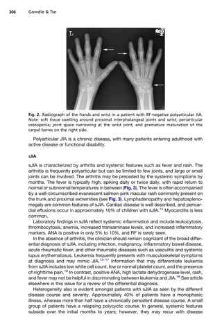 Juvenile Idiopathic Arthritis (2012) | PDF