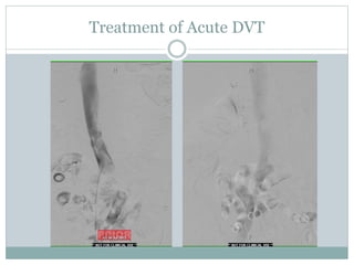 Venous Thromboembolic Disease and Current Management | PPTX