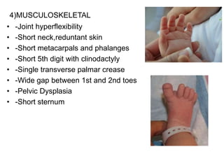 Down Syndrome | PPTX