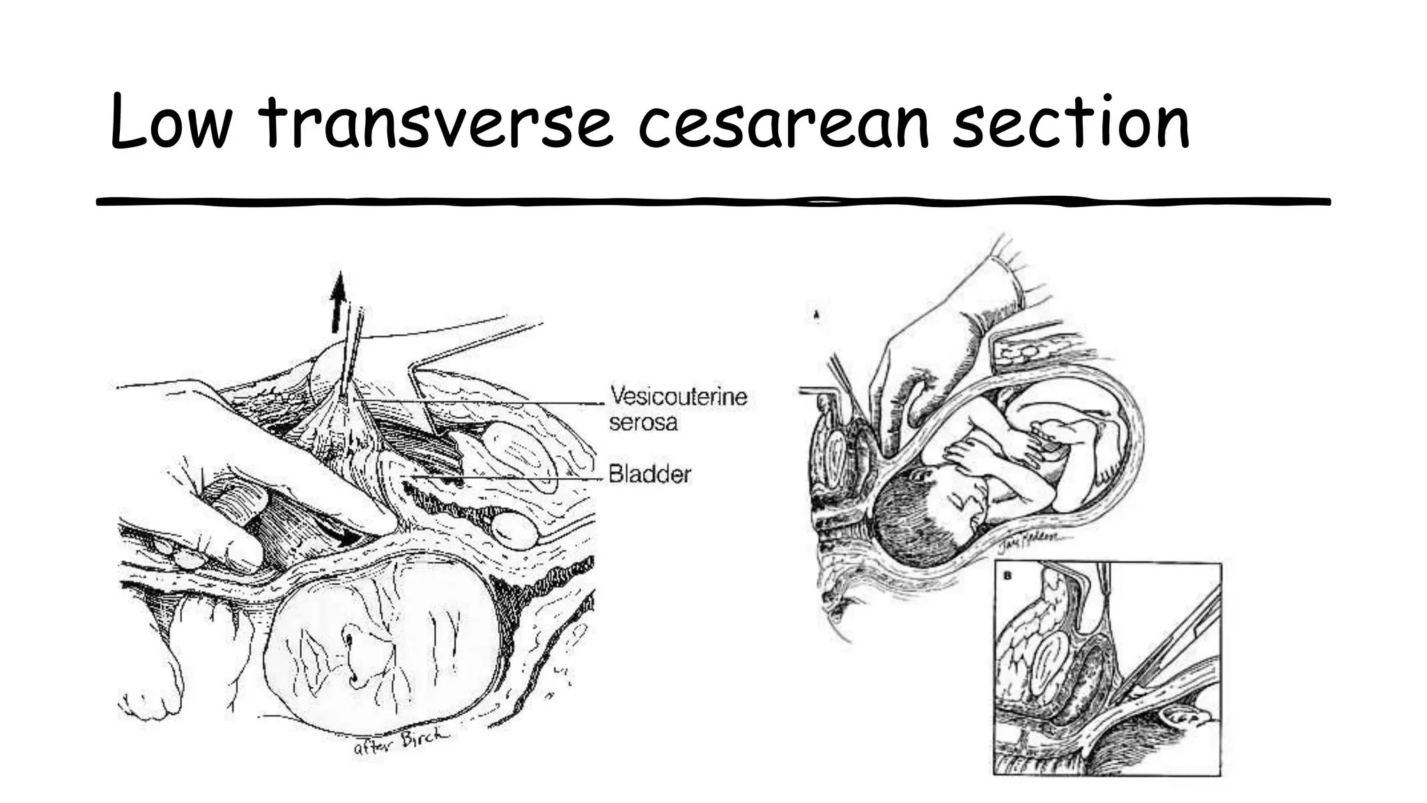 Indication_of_cesarean_section.pptx