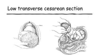 Indication_of_cesarean_section.pptx