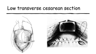 Indication_of_cesarean_section.pptx