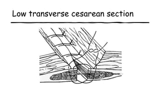 Indication_of_cesarean_section.pptx