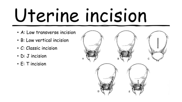 Indication_of_cesarean_section.pptx