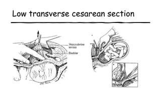 Indication_of_cesarean_section.pptx