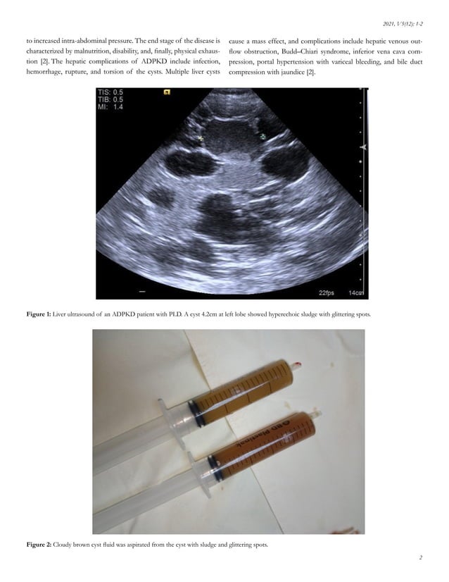 Hepatic Cysts with Cholesterol Crystal Formation: An Unusual Mimicker ...