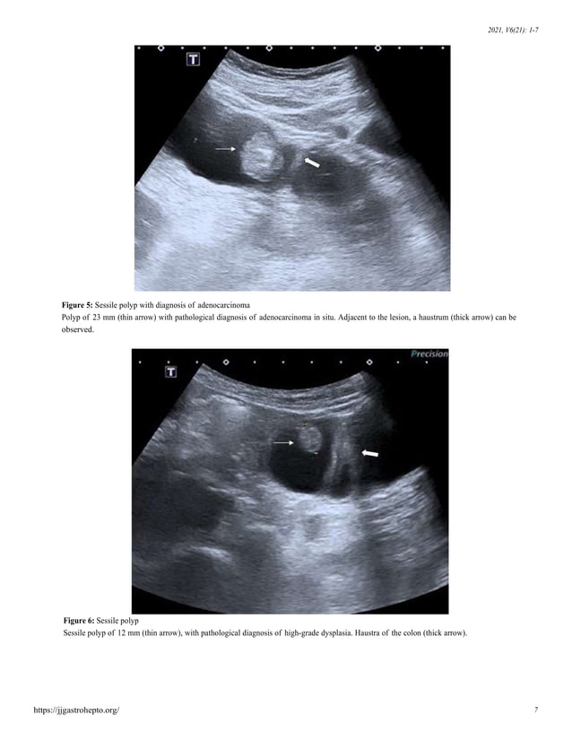 Hydrocolonic Sonography. A Forgotten Technique