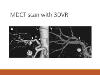 Hilar Cholangiocarcinoma | PPTX