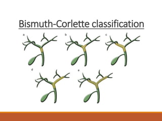 Hilar Cholangiocarcinoma | PPTX