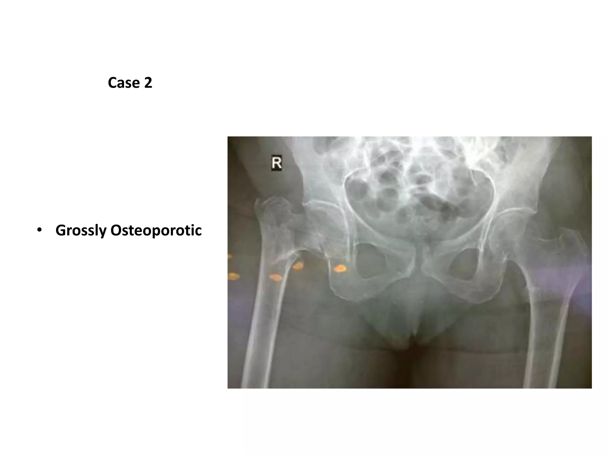 Role of THR in trochanteric fractures | PPTX