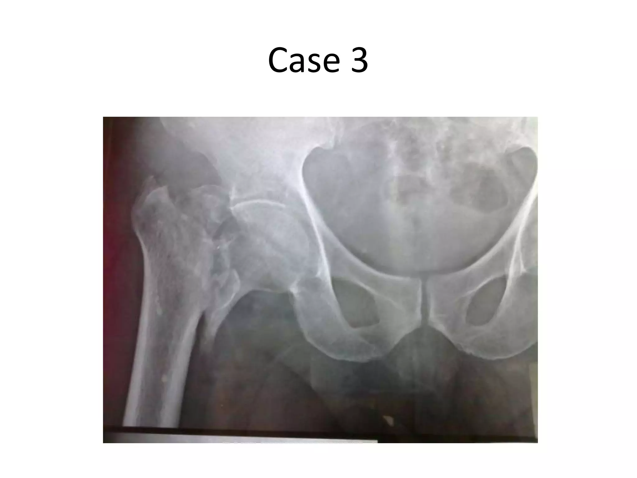 Role of THR in trochanteric fractures | PPTX