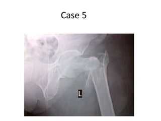 Role of THR in trochanteric fractures | PPTX