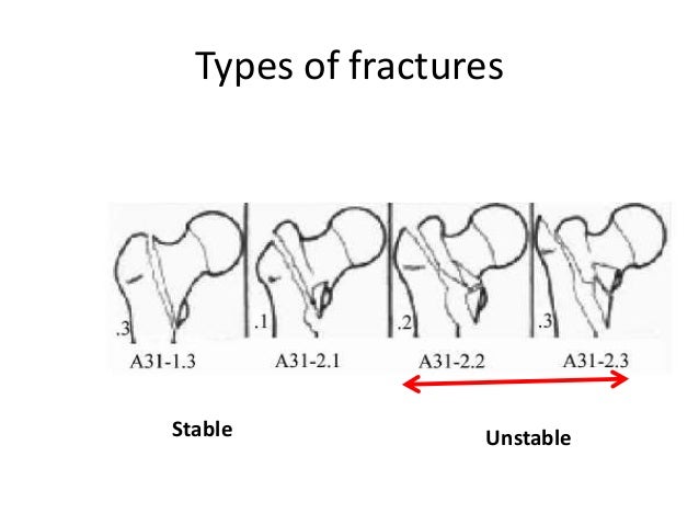 Role of THR in trochanteric fractures