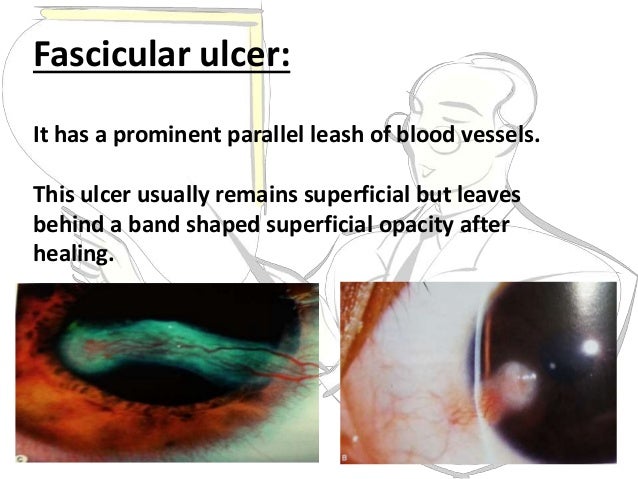Phlyctenular Keratitis