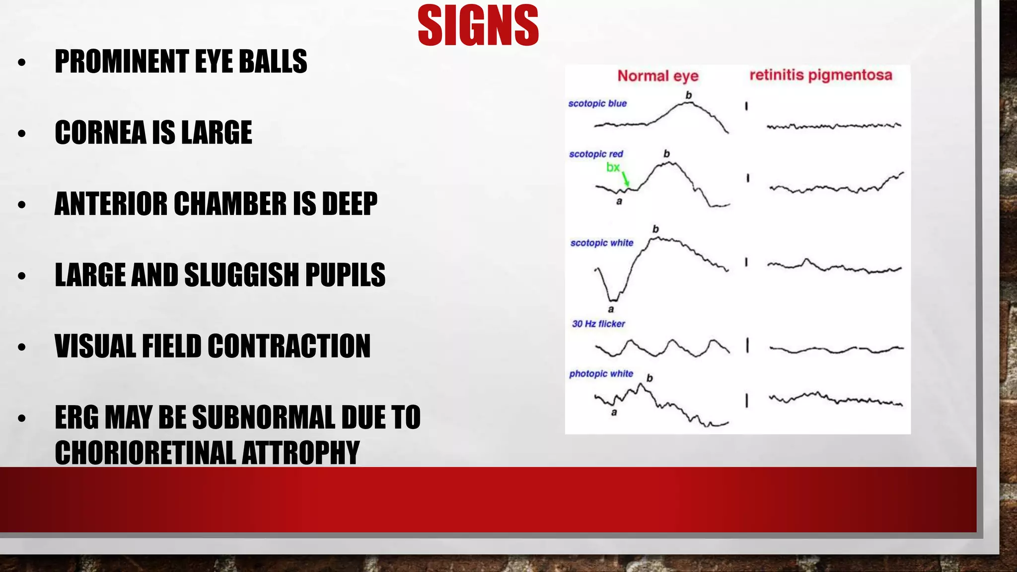 Pathological Myopia | PPTX