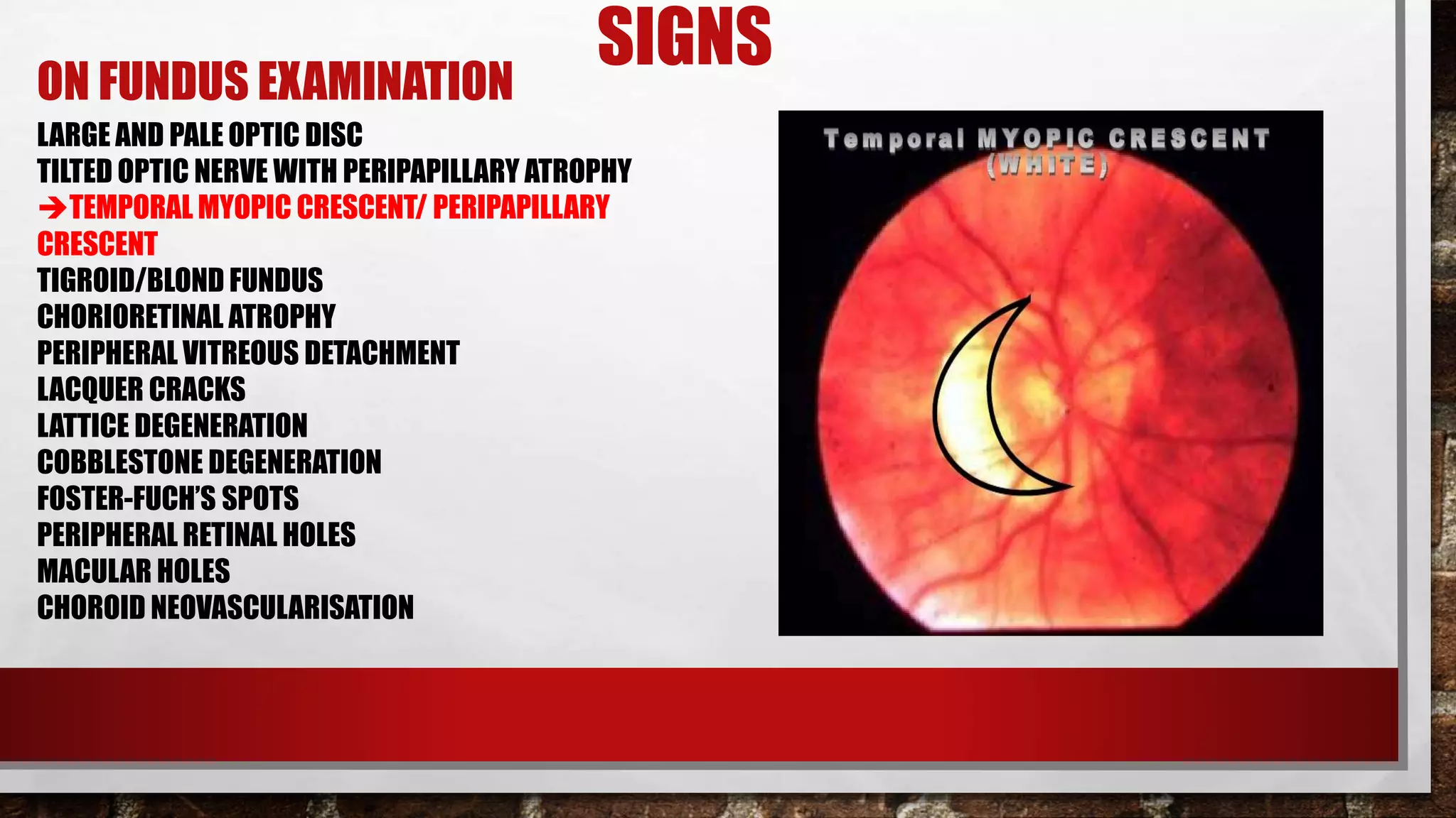 Pathological Myopia | PPTX