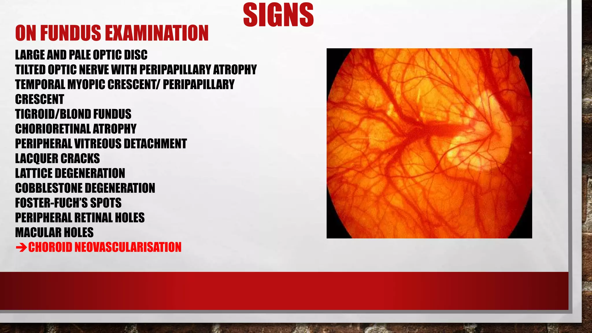 Pathological Myopia | PPTX