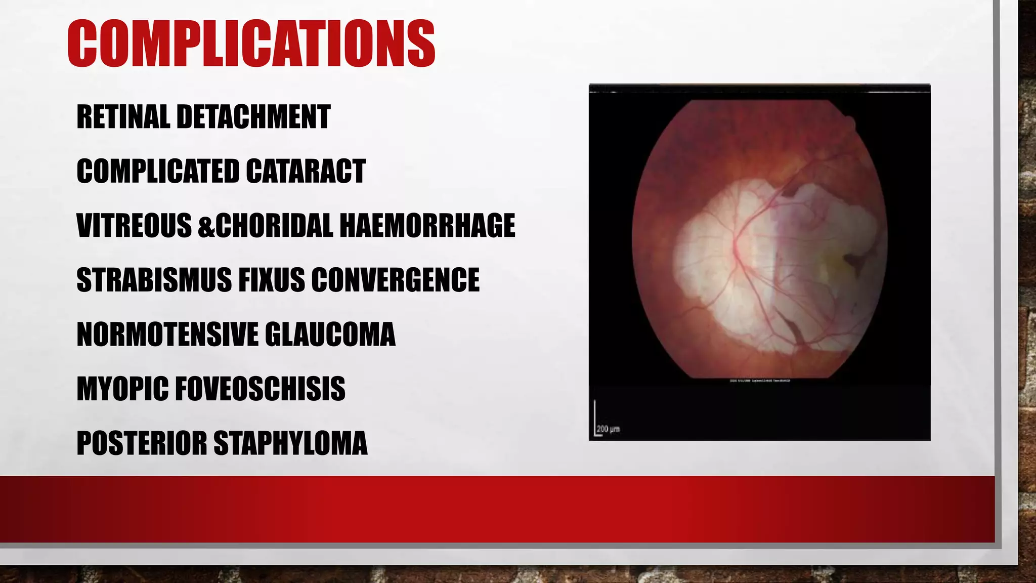 Pathological Myopia | PPTX