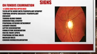 Pathological Myopia | PPTX