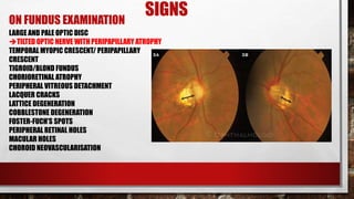 Pathological Myopia | PPTX