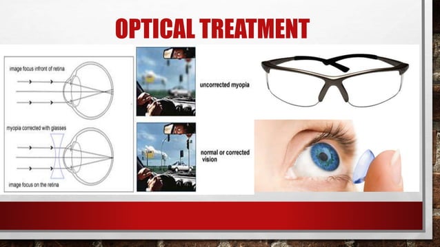 Pathological Myopia | PPTX