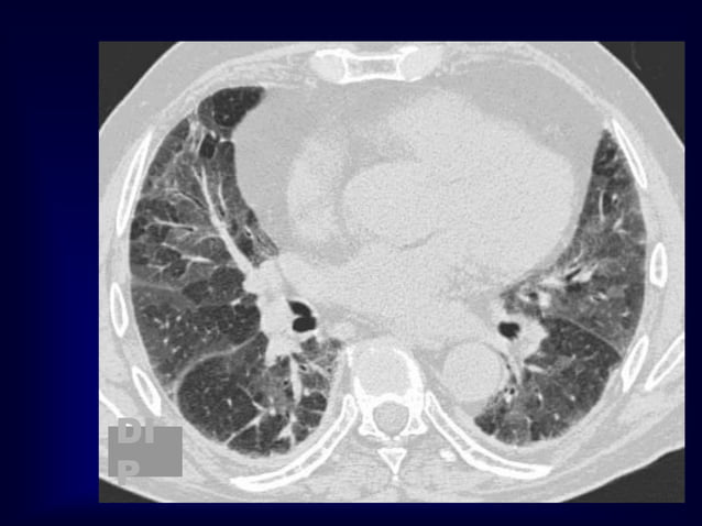Mosaic pattern | PDF | Lung and Respiratory Health | Diseases and ...