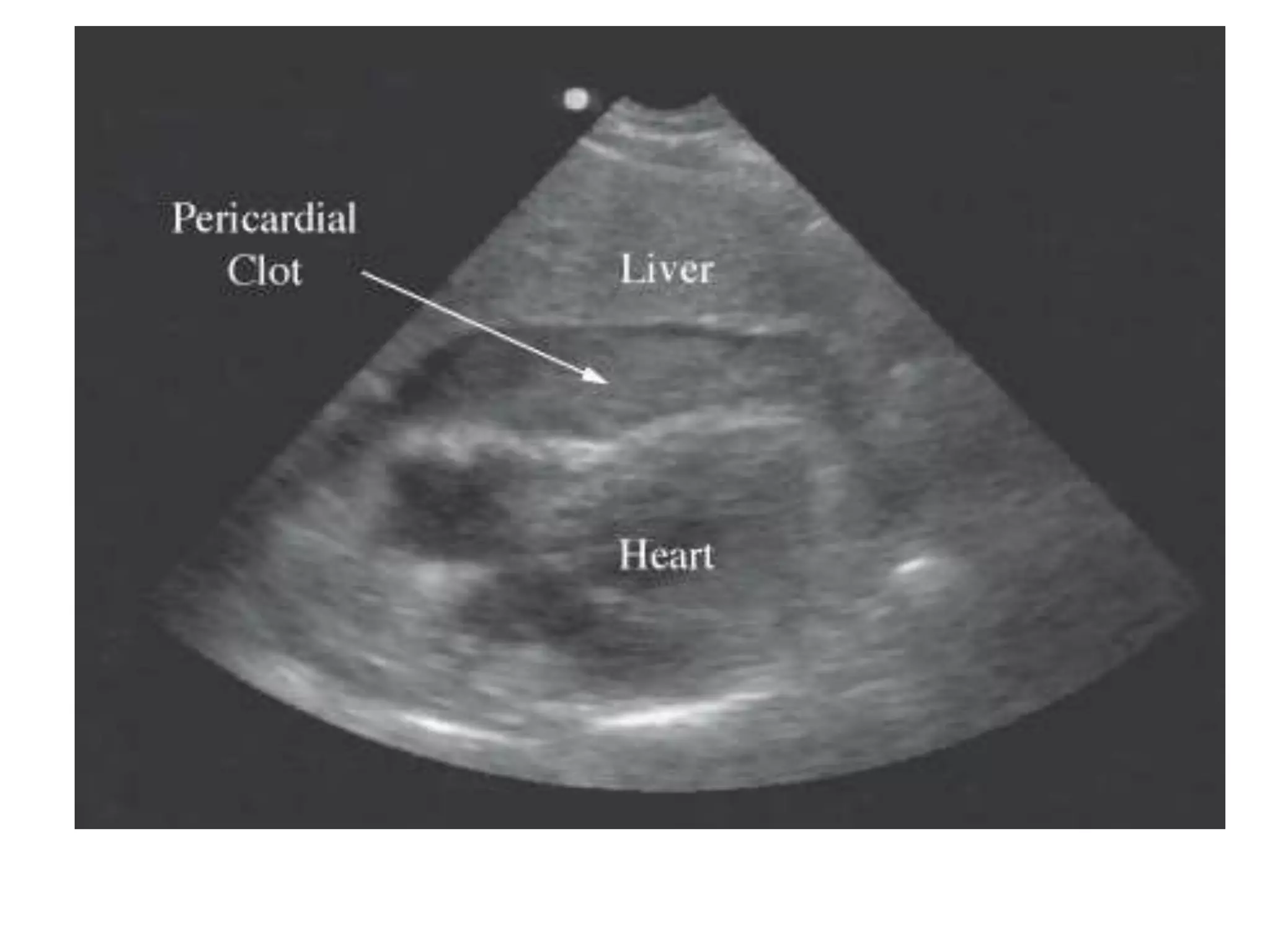 FAST (Focused Assessment Sonography for Trauma) | PPTX