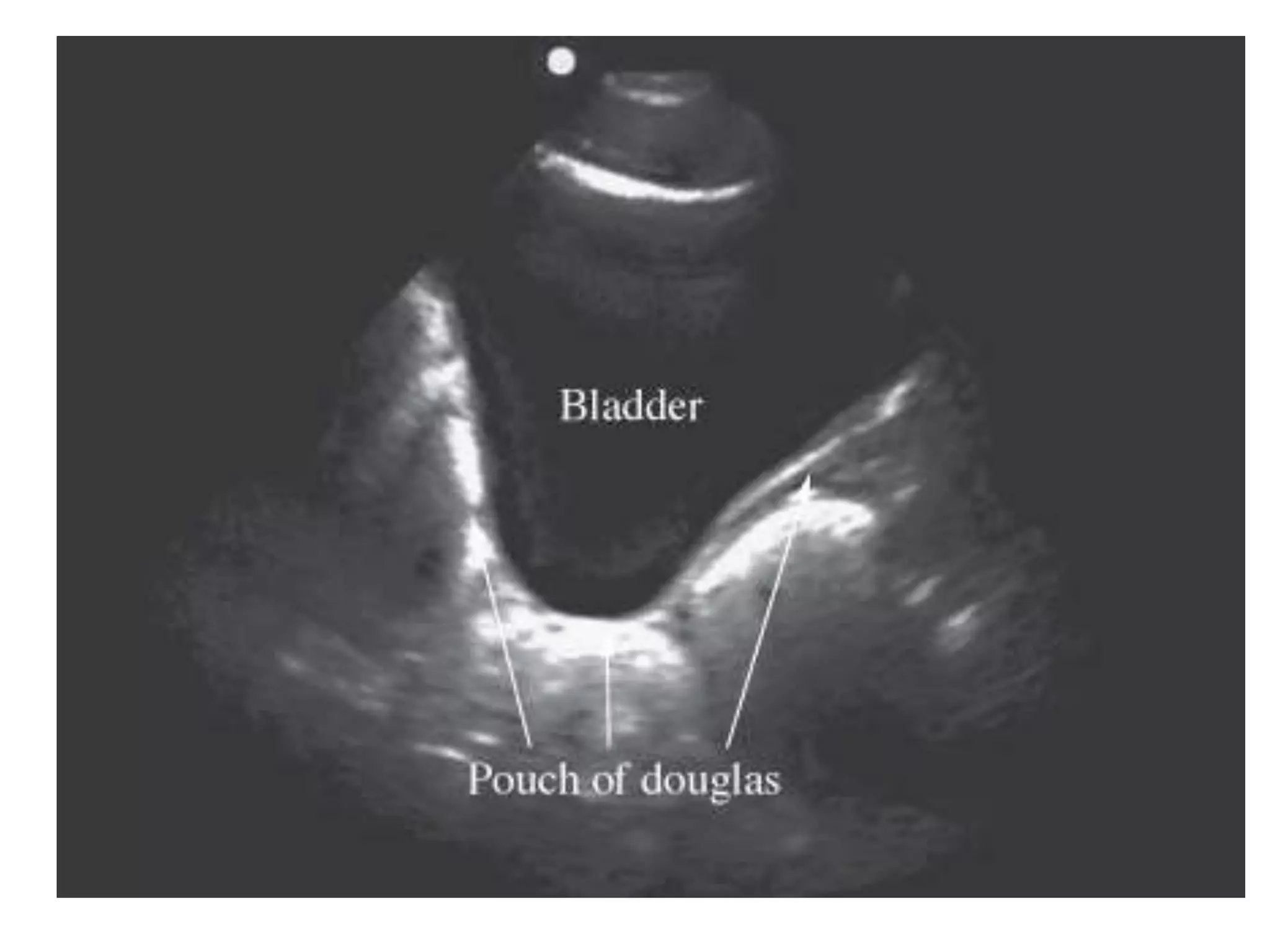 FAST (Focused Assessment Sonography for Trauma) | PPTX