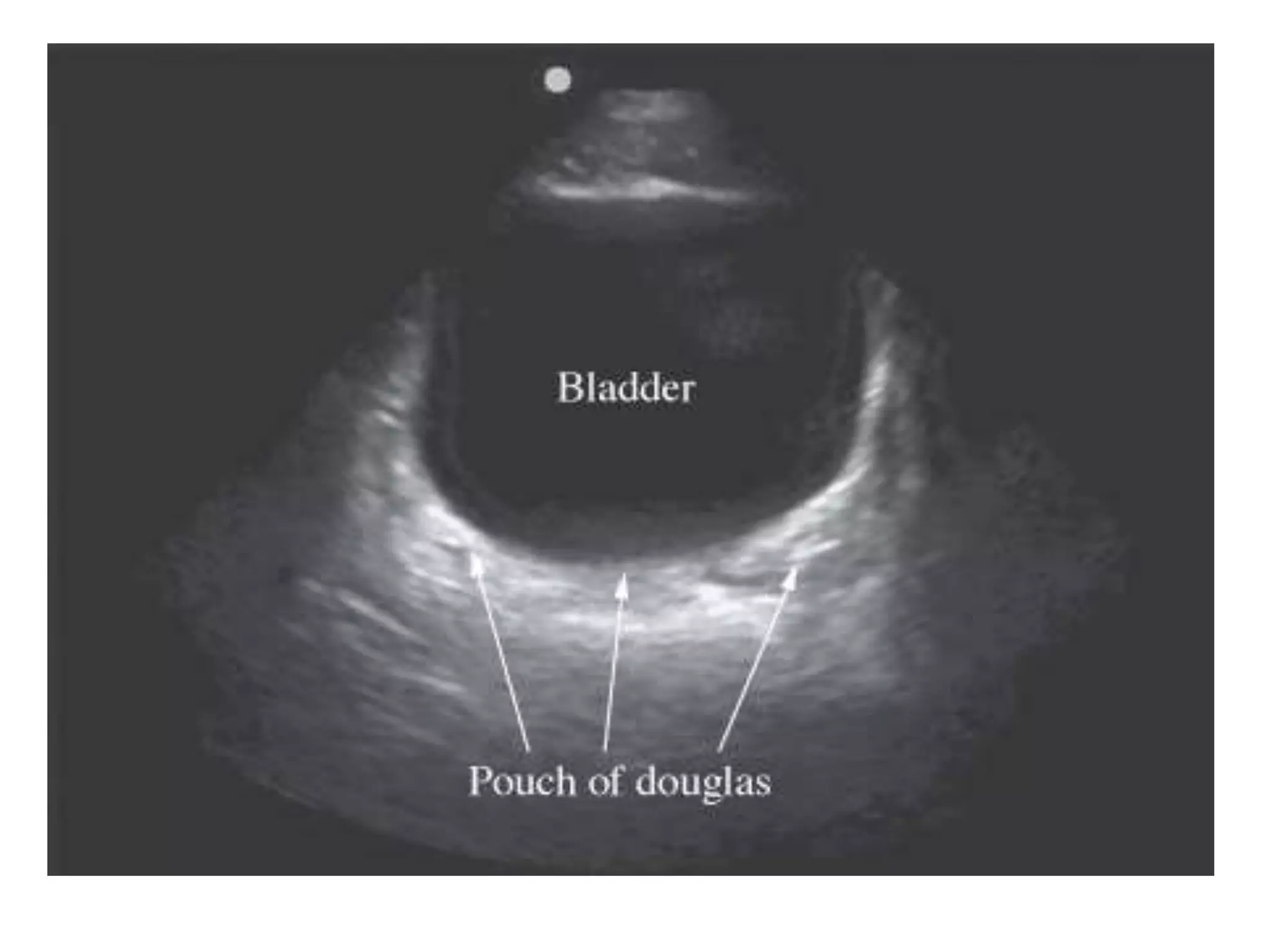 FAST (Focused Assessment Sonography for Trauma) | PPTX