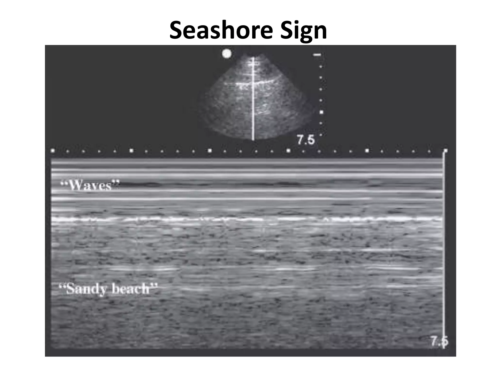 FAST (Focused Assessment Sonography for Trauma) | PPTX