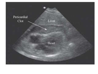 FAST (Focused Assessment Sonography for Trauma) | PPTX