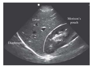 FAST (Focused Assessment Sonography for Trauma) | PPTX