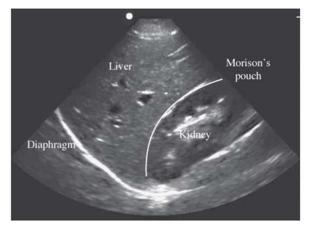 FAST (Focused Assessment Sonography for Trauma) | PPTX