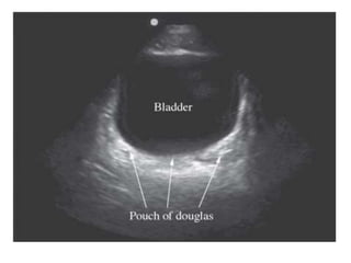 FAST (Focused Assessment Sonography for Trauma) | PPTX