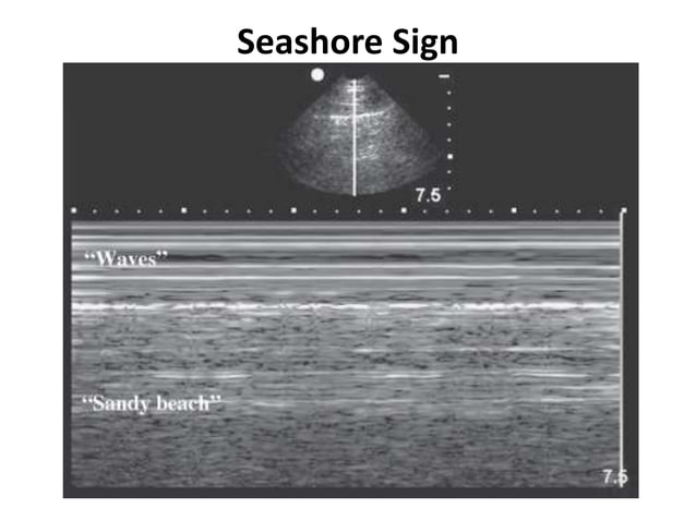 FAST (Focused Assessment Sonography for Trauma) | PPTX