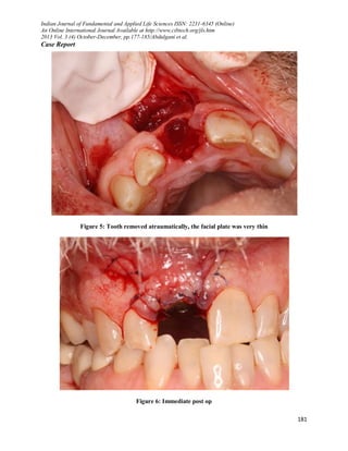 IMMEDIATE IMPLANT PLACEMENT WITH ONE YEAR FOLLOW-UP: A CASE REPORT | PDF