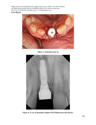 IMMEDIATE IMPLANT PLACEMENT WITH ONE YEAR FOLLOW-UP: A CASE REPORT | PDF