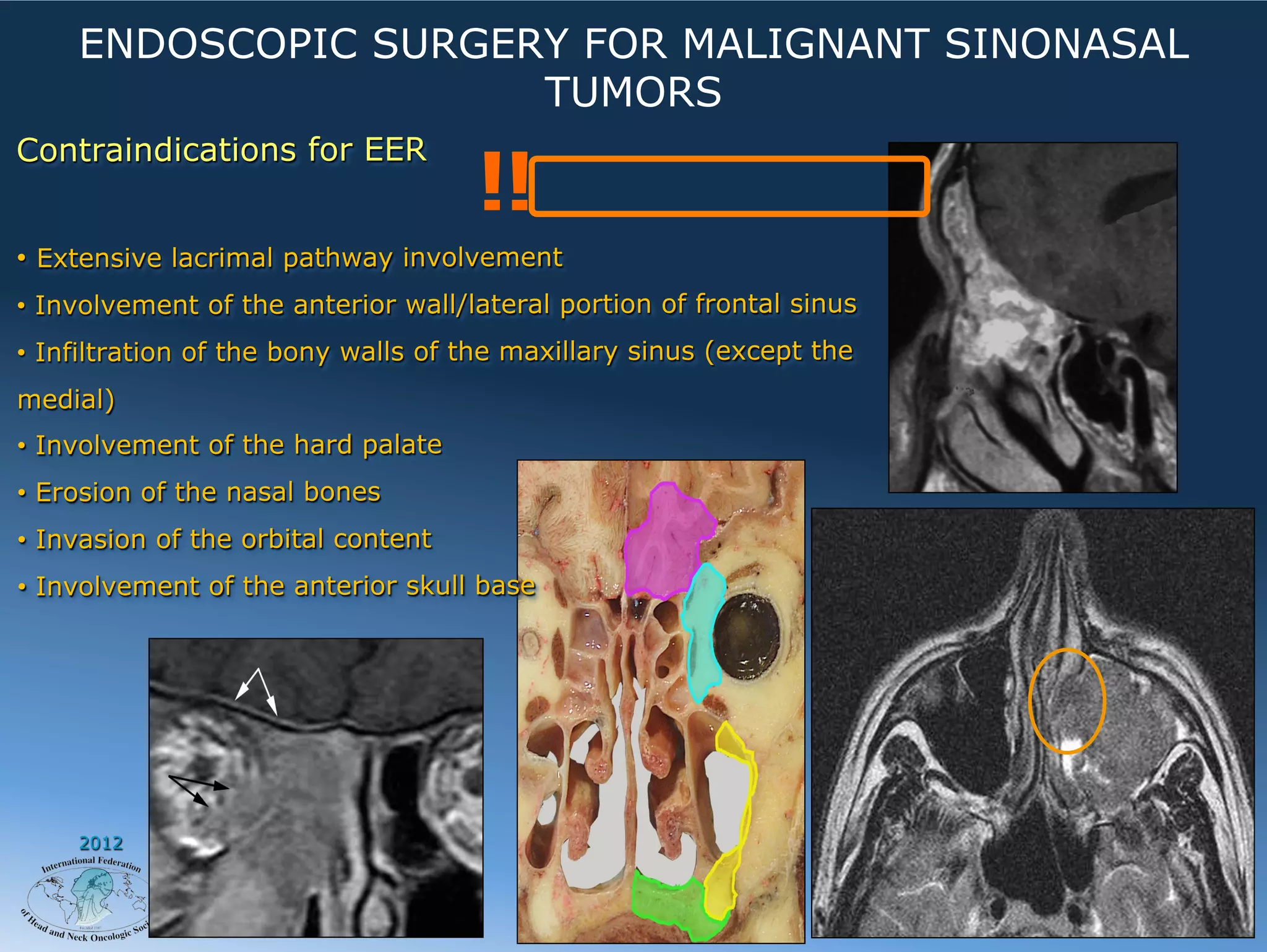 Minimally invasive sinus surgery by P. Nicolai | PDF