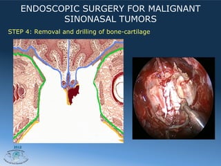 Minimally invasive sinus surgery by P. Nicolai | PDF